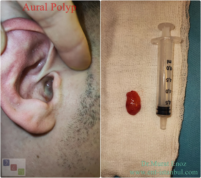Aural Polyps Definition Causes Symptoms And Treatment